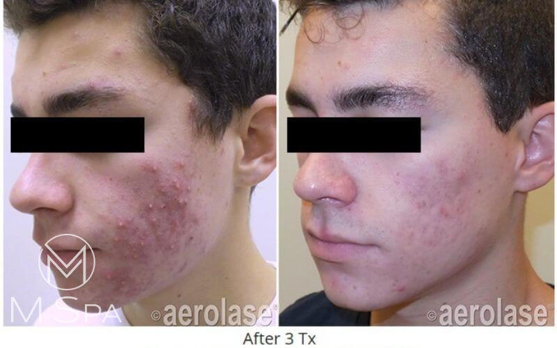 Acne Case 2 - Medical Spa Houston & Webster, TX | M Spa Face and Body